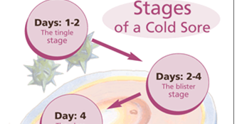 Herpes Dating Site, STD Dating Support: Signs of herpes at the early stage