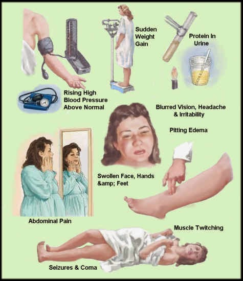 AKANG BELAJAR PRE EKLAMPSIA DAN EKLAMPSIA akang-belajar-pre-eklampsia-dan-eklampsia