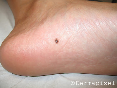 Dermapixel: marzo 2012