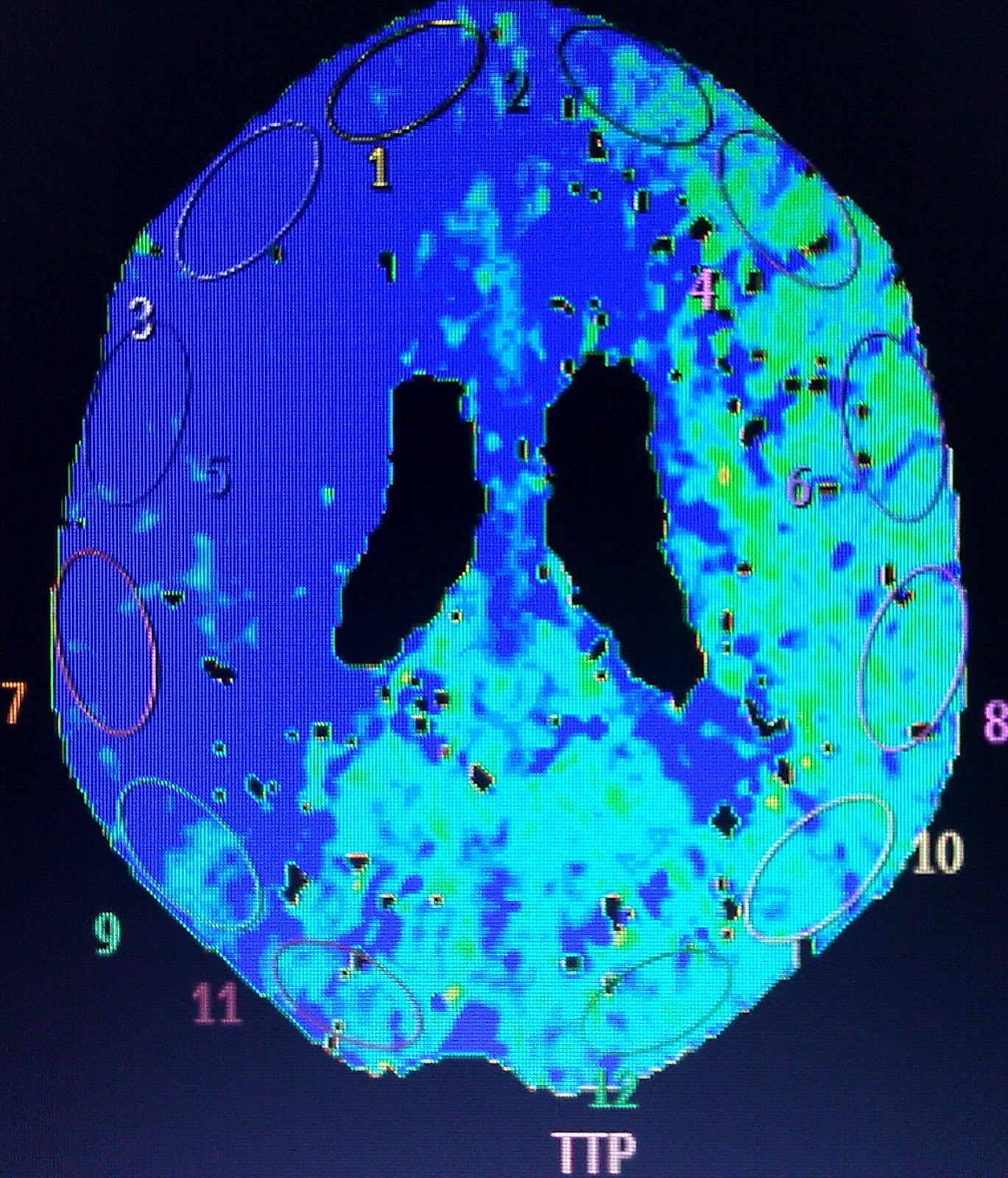 Learning Neuroradiology Case 604 infarct MCA ACA Hypoperfusion learning-neuroradiology-case-604-infarct-mca-aca-hypoperfusion
