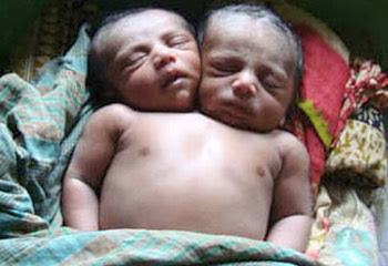 Three Headed Baby Born in Jefferson County