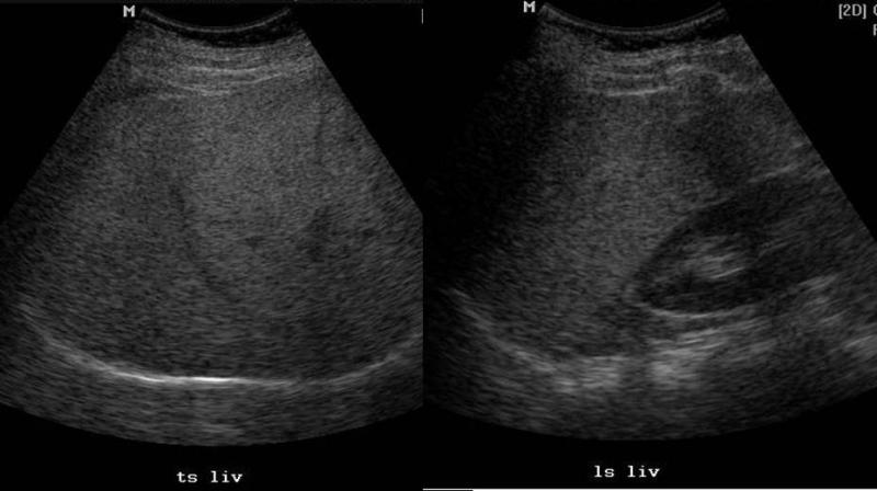 Primary Health Station Fatty Liver Please Check ALT primary-health-station-fatty-liver-please-check-alt