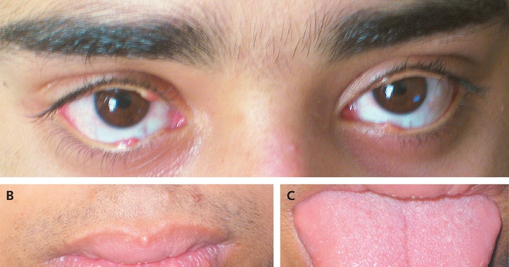 Papules On The Eyelids Lips And Tongue papules-on-the-eyelids-lips-and-tongue