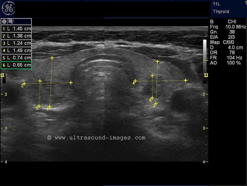 Ultrasound Imaging Elastography Of Thyroid Nodules ultrasound-imaging-elastography-of-thyroid-nodules