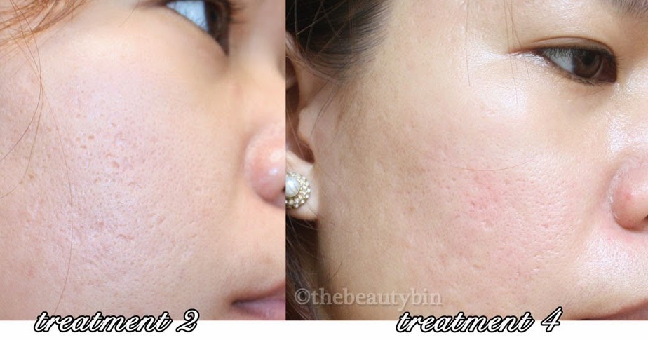 Fractional CO2 Laser for Acne Scars - Results, Photos, and the Rough ... Fractional CO2 Laser for Acne Scars - Results, Photos, and the Rough ...