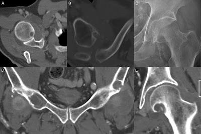 Roentgen Ray Reader: Amyloid Arthropathy