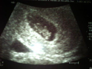 Angie's Mommy Blog: 9w4d ultrasound