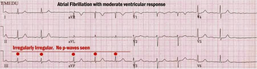 Atrial Fibrilation Fibrilasi Atrium Gangguan Irama At - vrogue.co Atrial Fibrilation Fibrilasi Atrium Gangguan Irama At - vrogue.co
