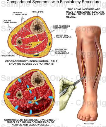 My Experience with Chronic Exertional Compartment Syndrome: Fasciotomy Surgery