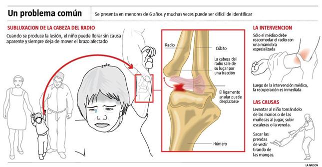 Yeso De Codo Dislocado