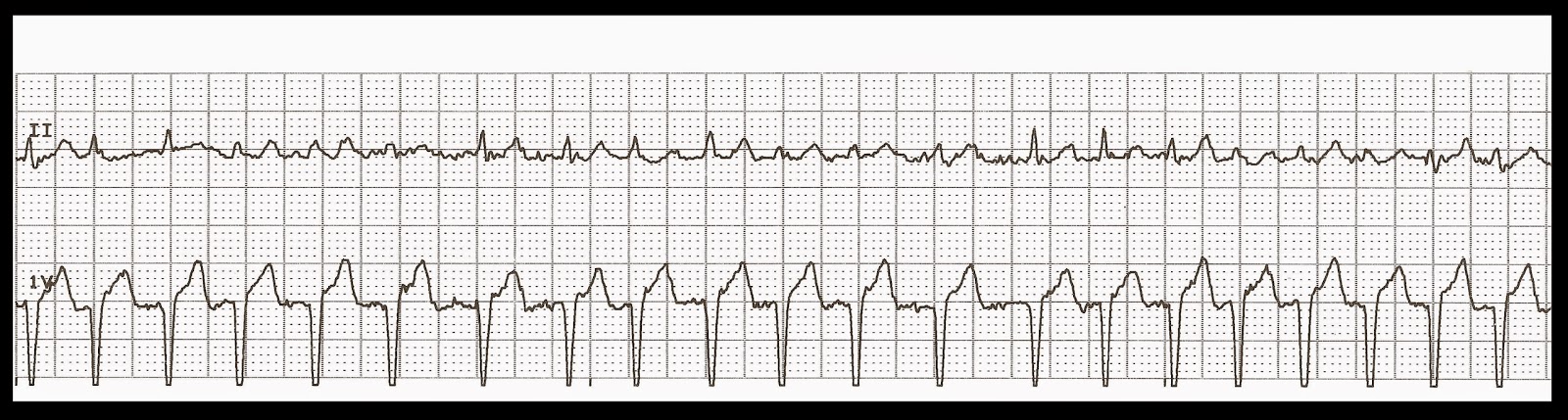 Float Nurse Practice EKG Strips 371 float-nurse-practice-ekg-strips-371