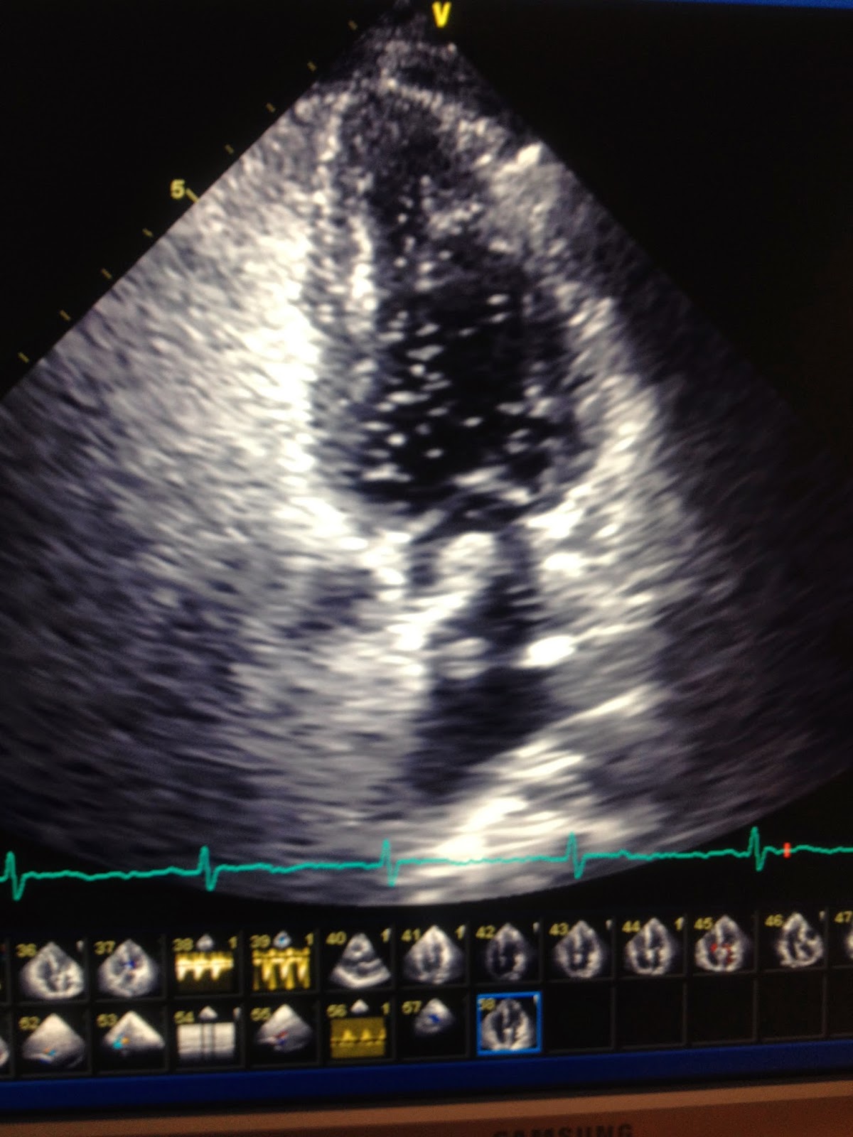 Kiwi Adventure Atrial Septal Aneurysm With Large PFO On Bubble Study kiwi-adventure-atrial-septal-aneurysm-with-large-pfo-on-bubble-study