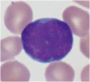 Hematología Fichas: Linfoblasto
