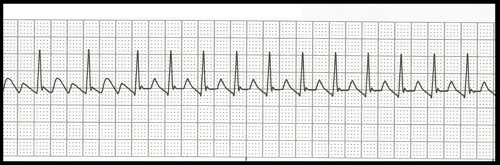 Float Nurse EKG Rhythm Strip Quiz 128 float-nurse-ekg-rhythm-strip-quiz-128