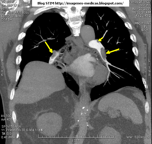 ESPE 202 - 2014: Caso clínico: TEP