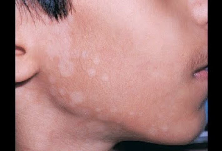 Pinpoint Red Dots On Skin Worsens When Running Mlatila pinpoint-red-dots-on-skin-worsens-when-running-mlatila