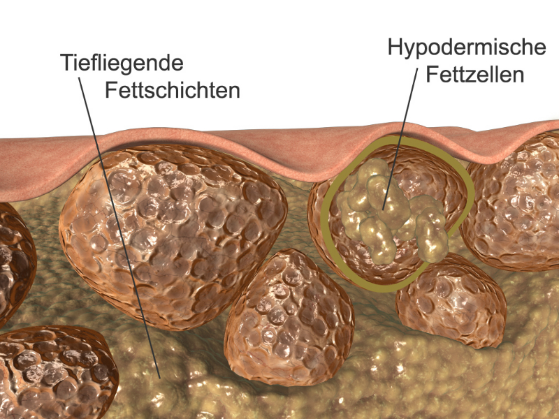 5 Ćwiczenia Cellulit – cellulit wodny Blog