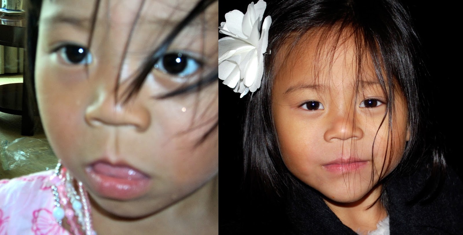 Bring my sons from afar...: BWS - Enlarged Tongue (macroglossia) Bring my sons from afar...: BWS - Enlarged Tongue (macroglossia)