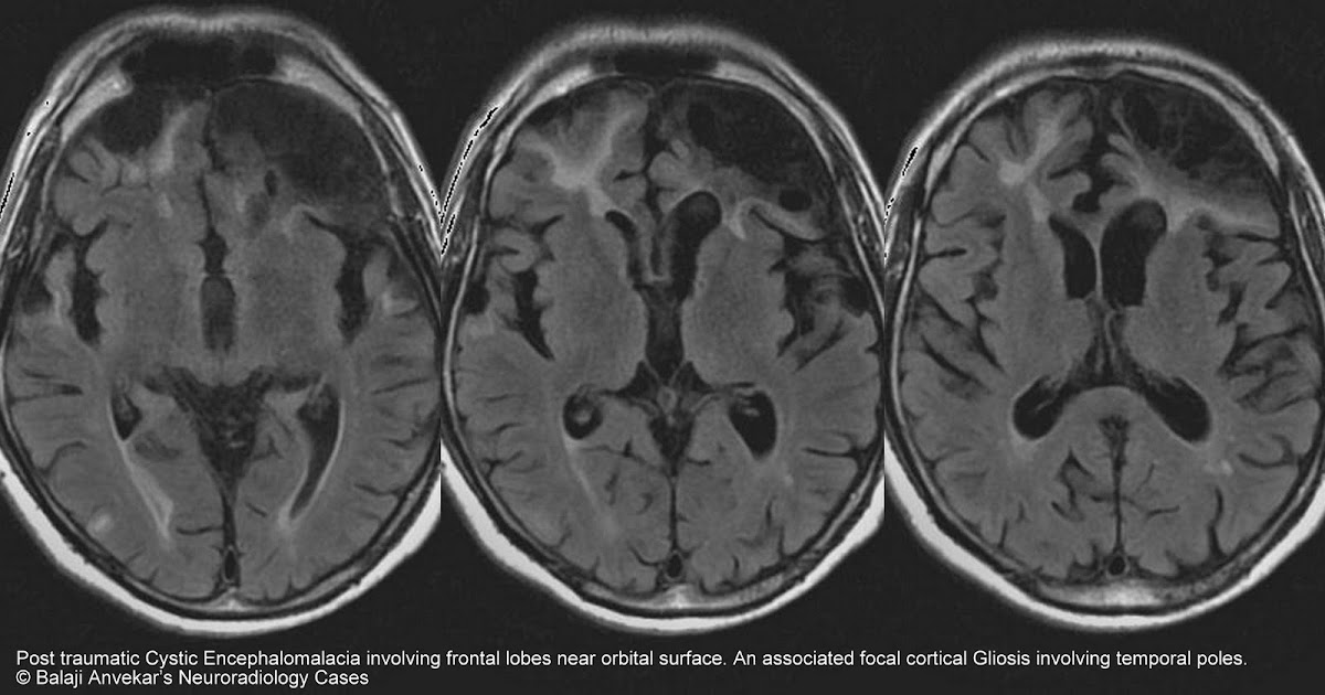 Neuroradiology Cases: Cystic Encephalomalacia MRI