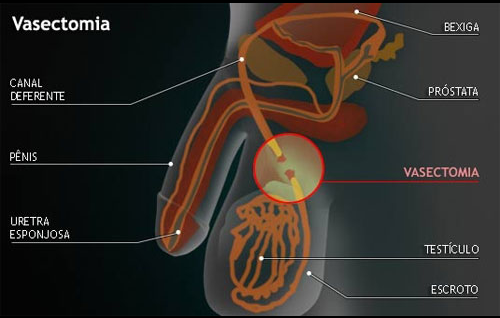 Farmacêutica Curiosa: Entenda como é feita a vasectomia