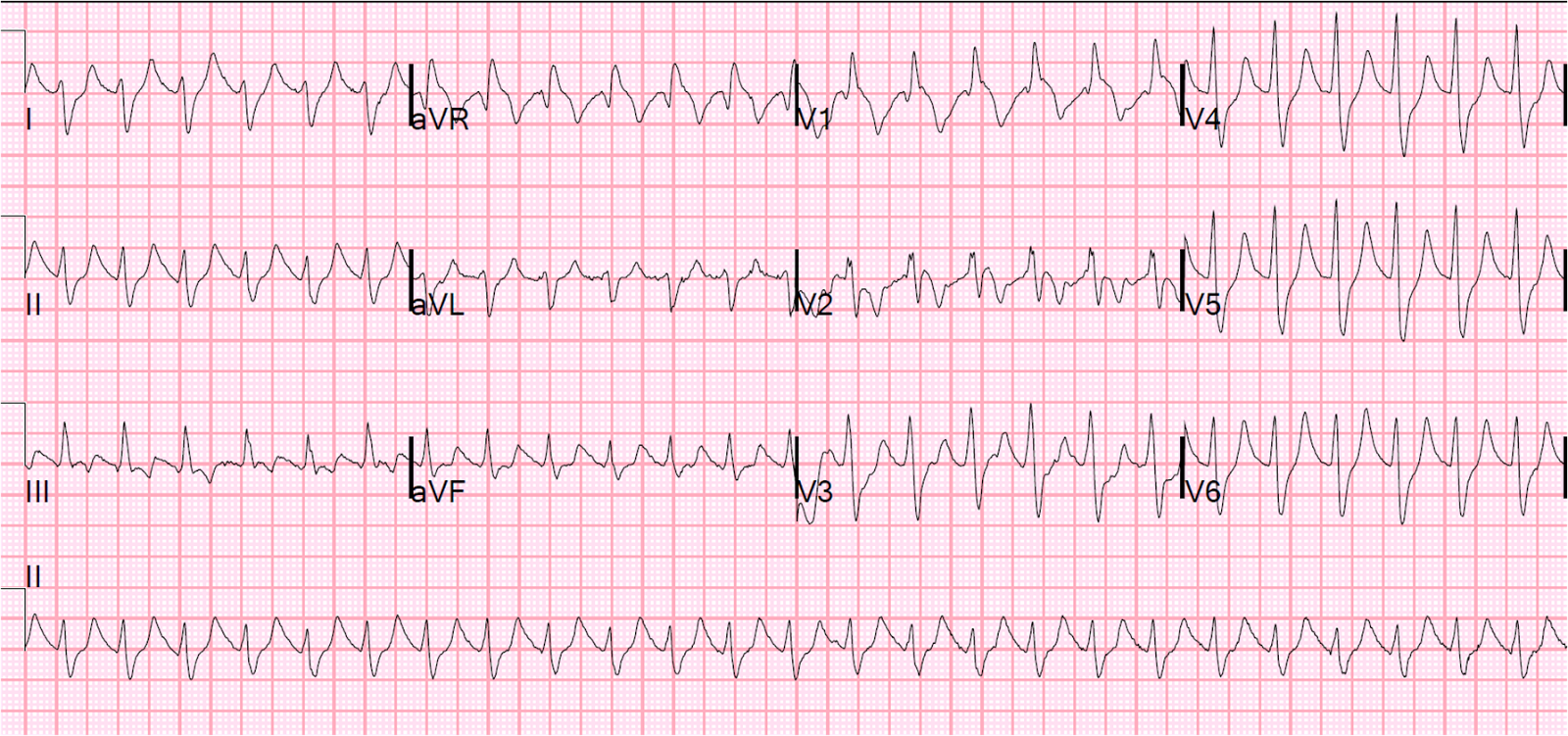 Dr. Smith's ECG Blog: Right Bundle Branch Block with ST Elevation in V1? Dr. Smith's ECG Blog: Right Bundle Branch Block with ST Elevation in V1?