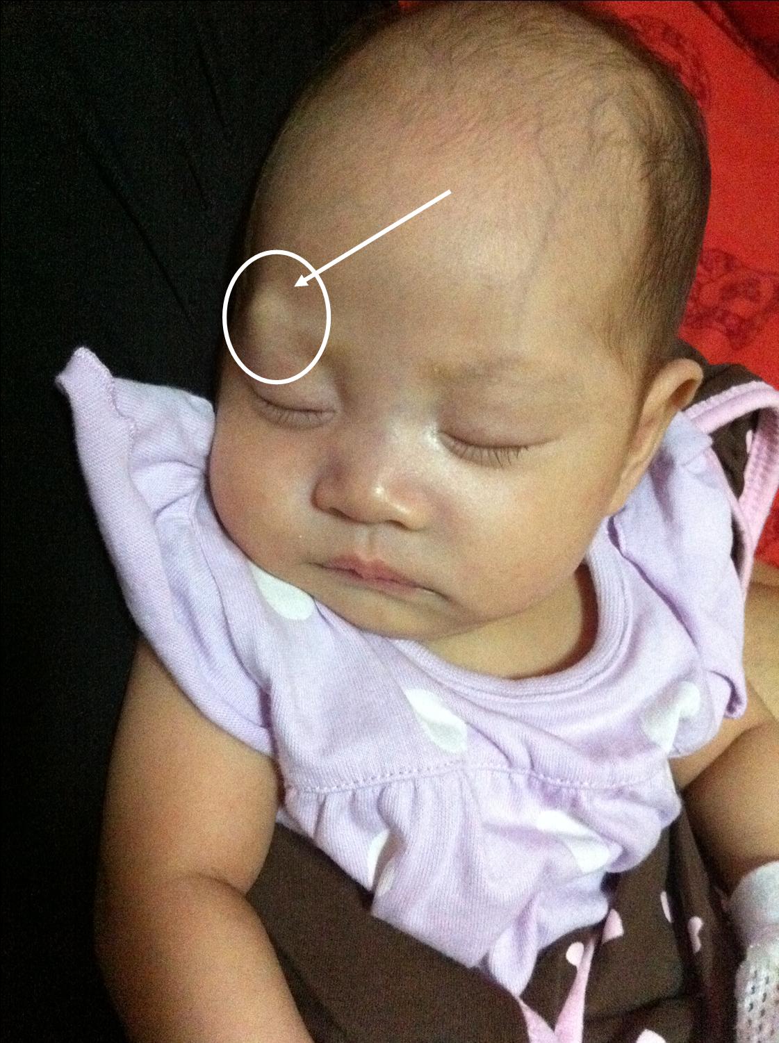 Dermoid Cyst dermoid-cyst