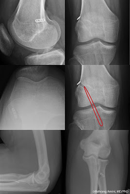 Roentgen Ray Reader: Endobutton