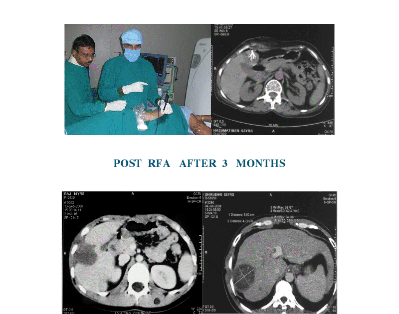 Radiofrequency Ablation of Malignant Liver Tumors - RF Ablation Liver Surgery ~ Radio Frequency ...