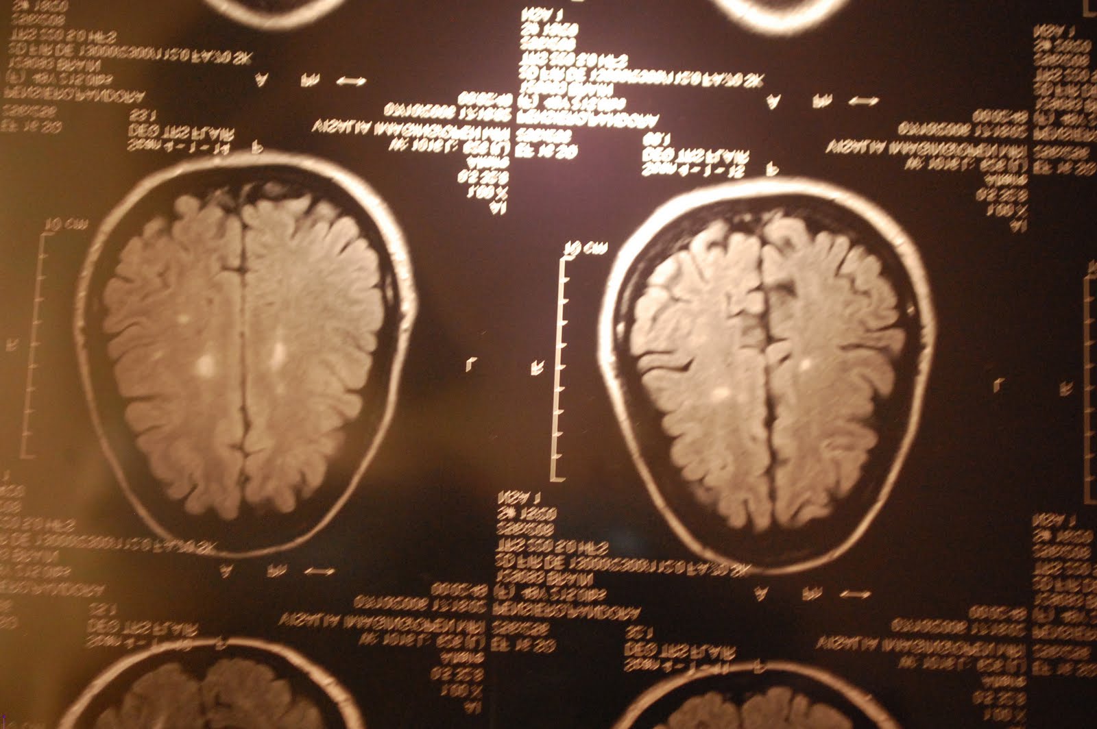Mri Brain Scan Results White Spots mri-brain-scan-results-white-spots