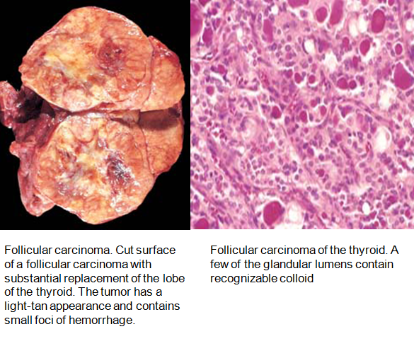 MBBS Medicine (Humanity First): Follicular Carcinoma. MBBS Medicine (Humanity First): Follicular Carcinoma.