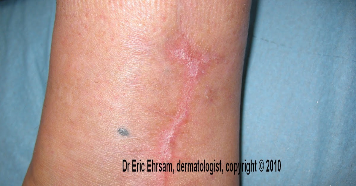 Dermoscopy Blue Lesion On A Leg dermoscopy-blue-lesion-on-a-leg