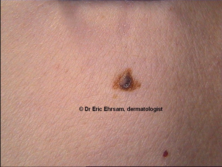 Dermoscopy Melanoma In Situ dermoscopy-melanoma-in-situ