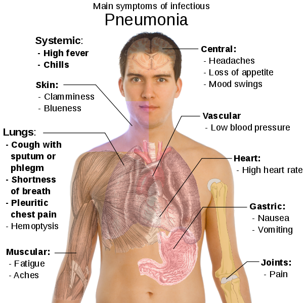 N O N 1 K Pneumonia n-o-n-1-k-pneumonia