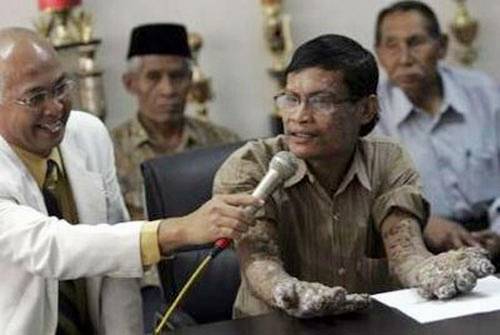 Dede Koswara After Treatment