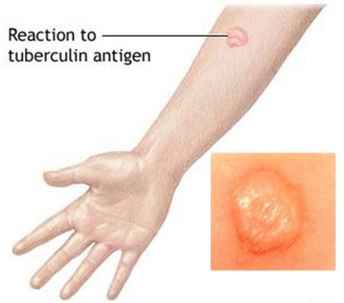 Phimaimedicine 423 Tuberculin Skin Test phimaimedicine-423-tuberculin-skin-test