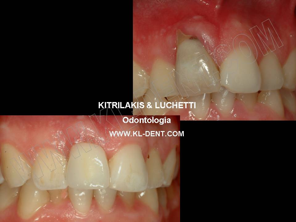 Kitrilakis & Luchetti - Dentistry: Dental Implant in Upper Central ... Kitrilakis & Luchetti - Dentistry: Dental Implant in Upper Central ...