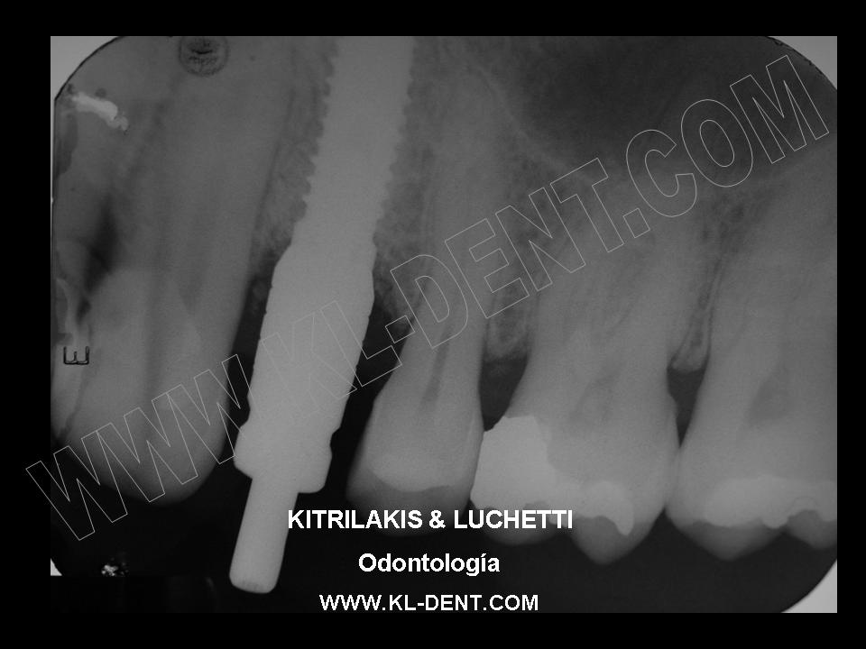 Kitrilakis & Luchetti - Dentistry: Dental Implant in Upper Premolar: Case 1 Kitrilakis & Luchetti - Dentistry: Dental Implant in Upper Premolar: Case 1