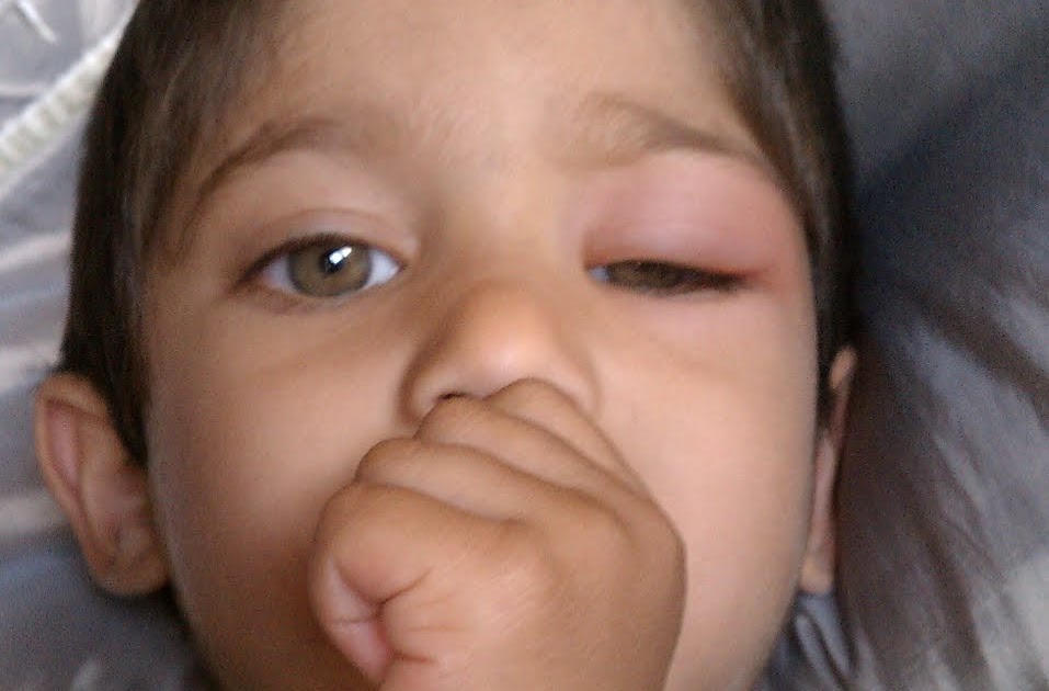 The Grotesquely Swollen Apple Of My Eye What To Do When Bugs Attack the-grotesquely-swollen-apple-of-my-eye-what-to-do-when-bugs-attack