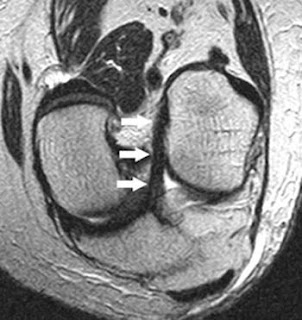 Radiology Channel: Anatomy of bundles of ACL and PCL.