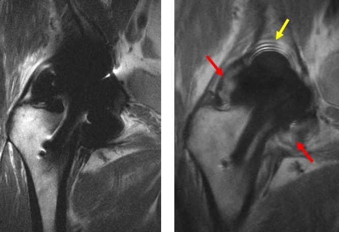 Hip on a Mission: PROCEDURES: MRI