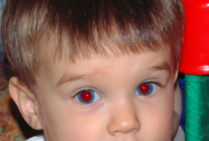 20/20 EYE GLASSES: Red eyes In Photographs