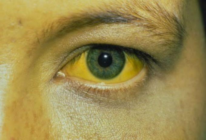 Jaundice: Symptoms, Causes, Diagnosis, and Homoeopathic Treatment of ...