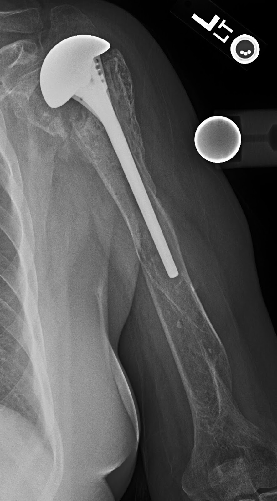 UW Shoulder and Elbow Academy: The humeral component: what's in a stem?