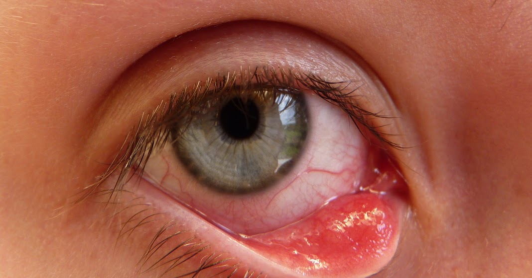 4 Natural ways to Cure Hordeolum ~ kesterluc