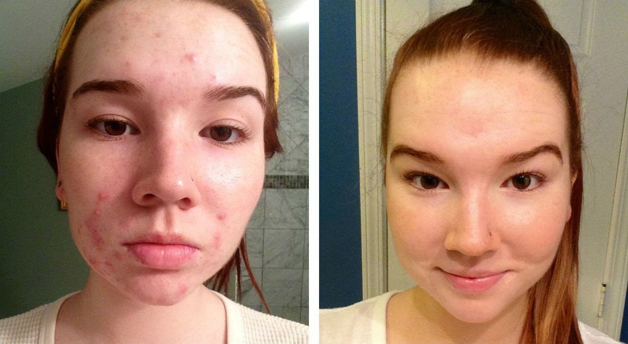 Comment se débarrasser de l’acné avec ce soin naturel pour le visage ...