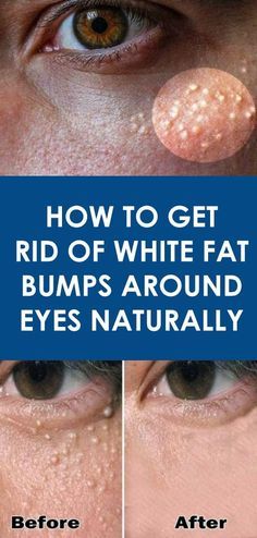 How To Get Rid of White Fat Bumps Around Eyes Naturally | Health