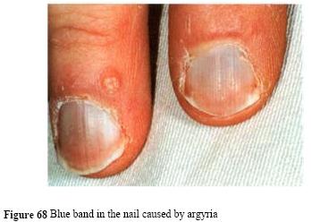 Nail Diseases: Blue Nails