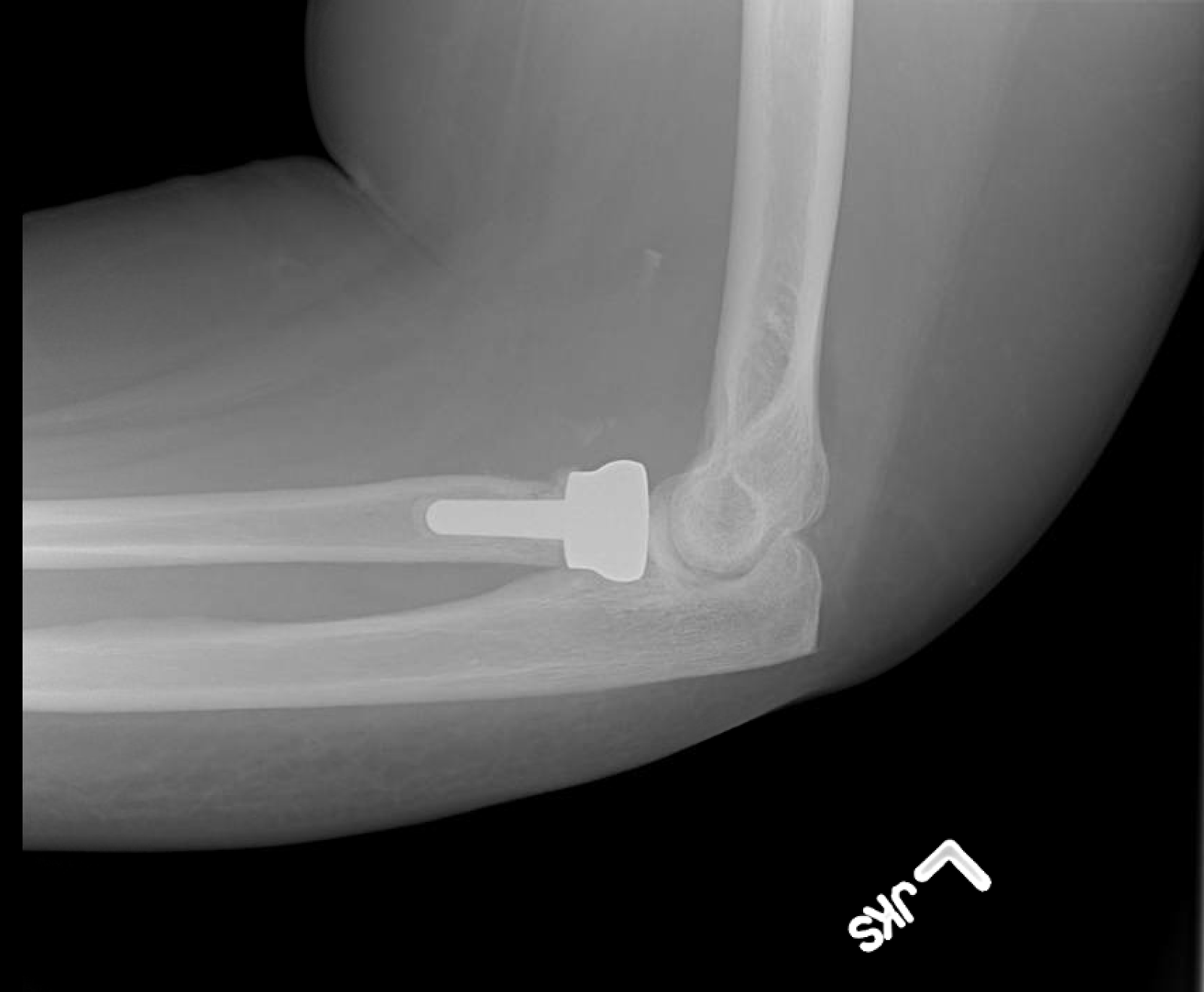 Shoulder and Elbow Surgery: Terrible triad injury. The importance of ...