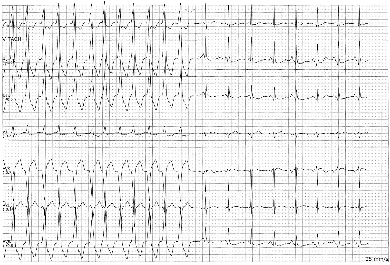 Sinus Rhythm with a Run of VT