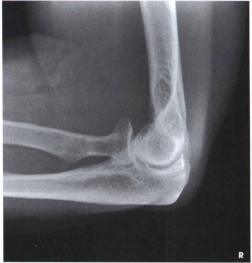 Proyeksi Pemeriksaan Elbow Joint | Aditya Radiografer